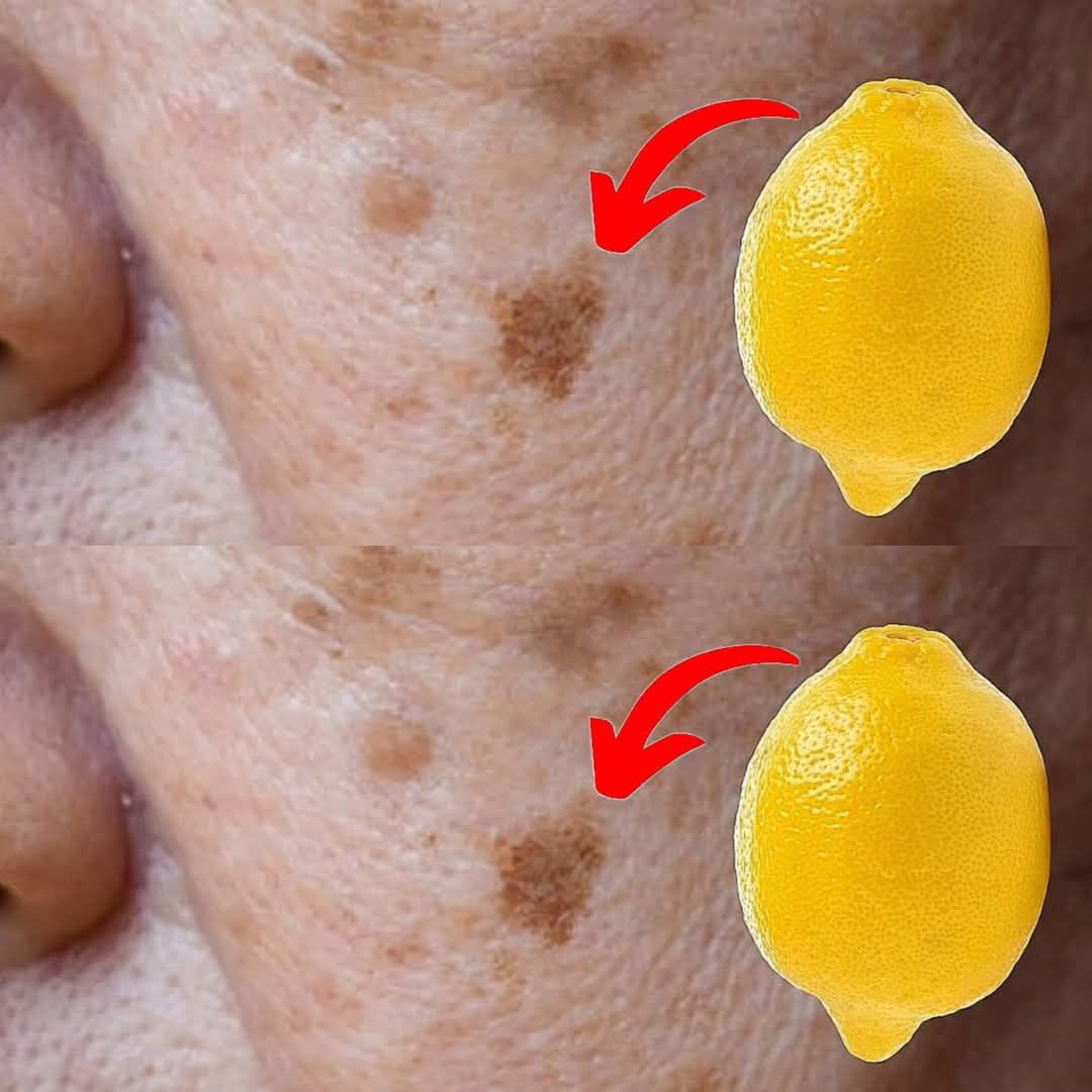 How to Remove Age Spots with Lemons – Best Recipes