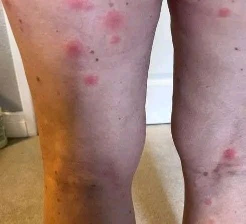 Not sure if these are mosquito bites or something else – Best Recipes